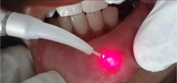 Laser Surgery for Mucoceles Excision - Siflaser- by SIFSOF, California