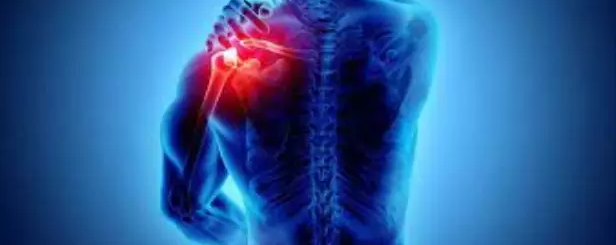 Laser Therapy For Shoulder Impingement Syndromes - Siflaser- by SIFSOF ...