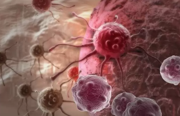 Laser Therapy for Adenocarcinoma Issue - Siflaser- by SIFSOF, California