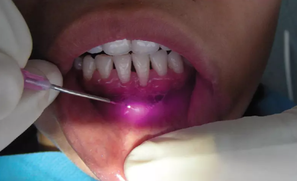 Vestibuloplasty Using 980nm Diode Laser - Siflaser- by SIFSOF, California